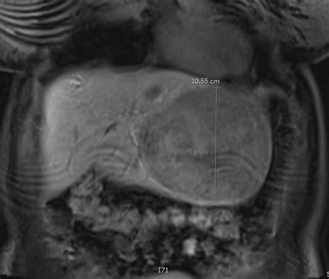 Giant Mixed Beta Catenin Inflammatory Hepatic Adenoma Acs
