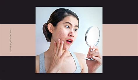 Difference Between Acne Marks Vs Acne Scars