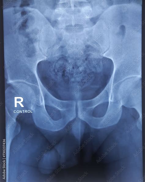 X Ray Film Of Rgu And Mcu Retrograde Urethrogram And Micturating