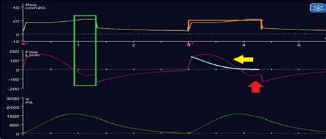 Severe Work Shifting In A Patient Undergoing Volume Control Ventilation