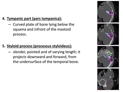 Mastoid Diseases Imaging Pptx