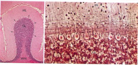 Cellular Pathology Edema Hydrocephalus And Herniations Of The Cns