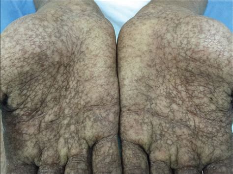 Dermatopathia Pigmentosa Reticularis Report Of A New Cases And