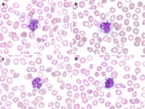 Monocytosis Springerlink