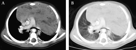 Hyperplasia Thymic Hyperplasia At Ralph Livingston Blog