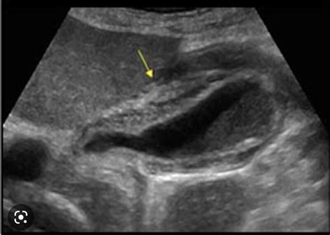 Maram Mohammed Fathi Ahmed On Linkedin Gallbladder Fishmouth