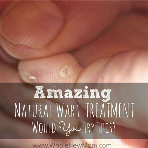 Water Warts Home Treatment At Annabelle Toomey Blog