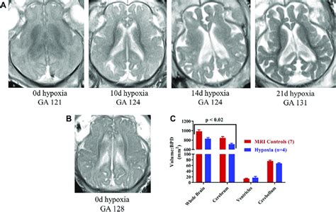 Magnetic Resonance And Brain Dysmaturity Findings After Hypoxia A