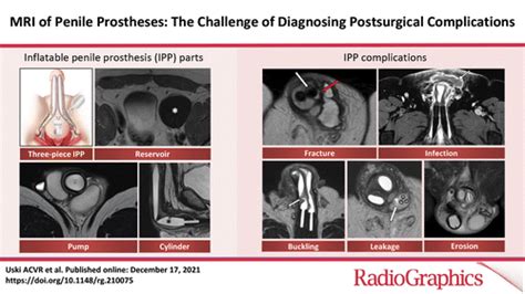 Mri Of Penile Prostheses The Challenge Of Diagnosing Postsurgical