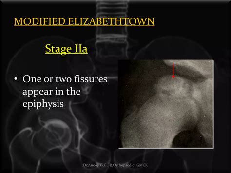 Classification Perthes Disease Pdf