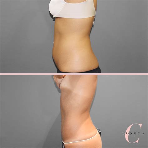 Is Vaser Liposuction Permanent Liposuction Sydney