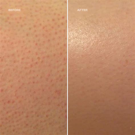 Say Goodbye To Rough Skin Your Guide To Keratosis Pilaris — Gabriella Sebestyen