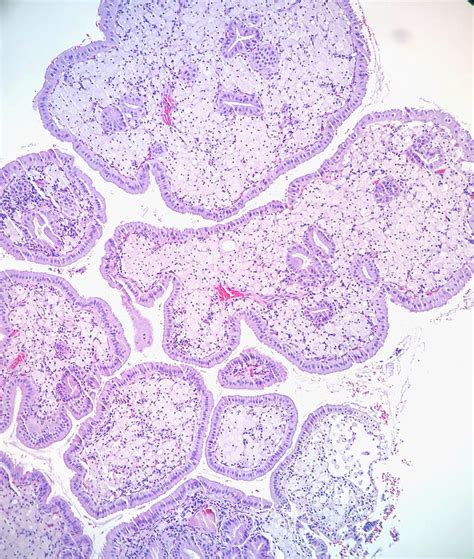 Cholesterol Polyp In The Gallbladder Pathosomes