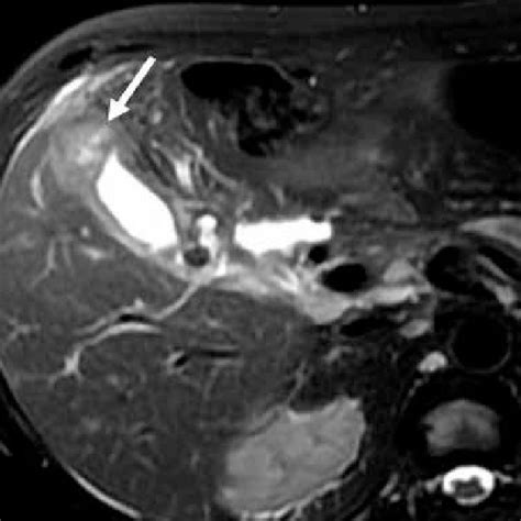 Pdf Mri Of Gallbladder Cancer