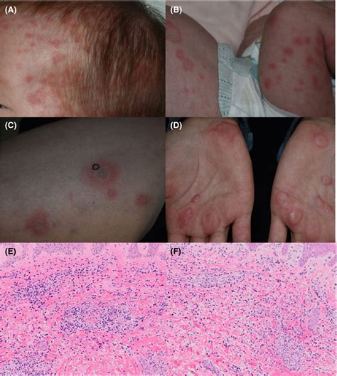 A B Skin Rash With Annular Erythematosus Lesions On The Face Trunk