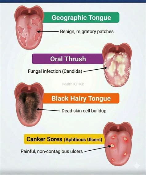 1️⃣ Geographic Tongue Also Called Benign Migratory Glossitis What It