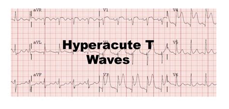Hyperacute T Waves Archives Emdocs
