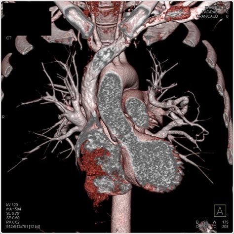 Pulmonary Arteriovenous Malformation Avm Chest Radiology Case
