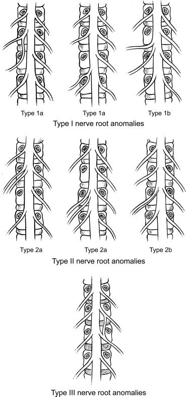 Conjoined Nerve Roots Of The Lumbar Spine The Spine Journal