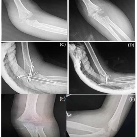 The Boyd And Griffin Classification Download Scientific Diagram