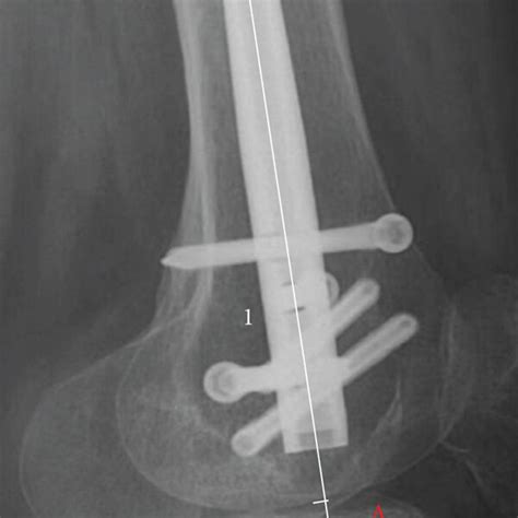 Measurement Of Deviation A On The Sagittal Plane Line Segment 1 Is