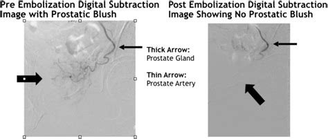 Pre And Post Embolization Fluoroscopic Images Showing The Occlusion Of