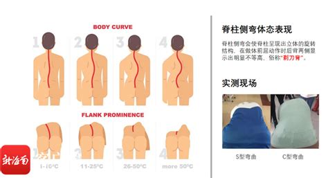 海口对全市25万名中小学生开展脊柱侧弯免费筛查 预计12月底完成 新闻中心 南海网