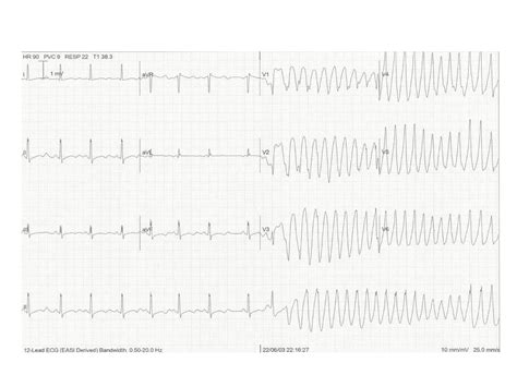 Ecg Wide Qrs Tachycardia Ppt
