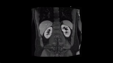 Protocolo Rm Abdomen Estandar Youtube