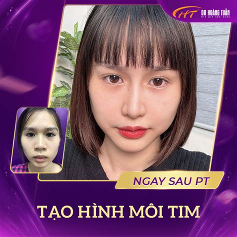 TẠo HÌnh MÔi Tim