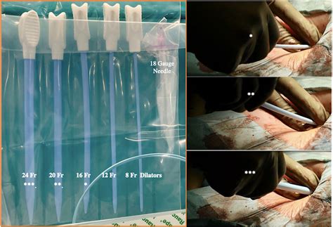 Progressive Increase In Vascular Kit Dilator Diameter To Perform Download Scientific Diagram