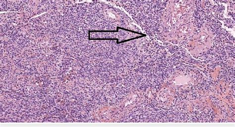 Histopathology Section Showing Increased Mitotic Index Cellular