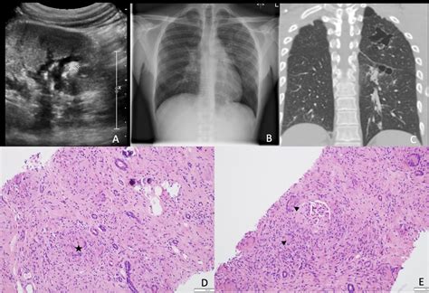 A Case Of The Noncaseating Granuloma Clinical Journal Of The American