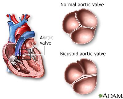 Bicuspid Aortic Valve Medlineplus Medical Encyclopedia Image