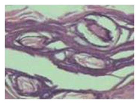 Simultaneous Larva Migrans And Larva Currens Caused By Strongyloides