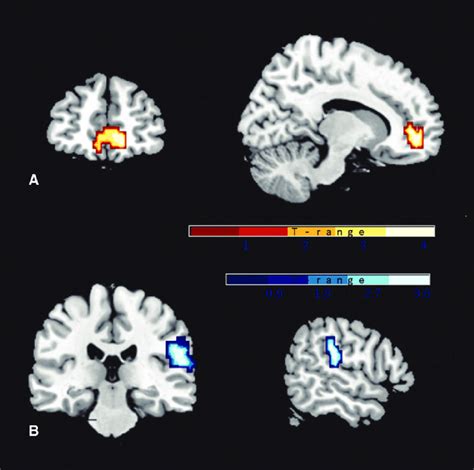 Functional Connectivity Results For The Posterior Cingulate Cortex Seed