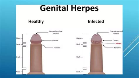 Sex Transmitted Diseases Ppt