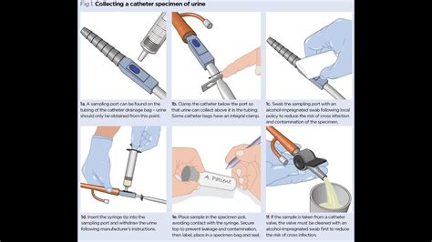 Suprapubic Catheter Leaking Persistent Urine Leakage Around A