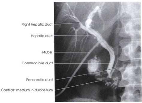 Postoperative Cholangiography Radtechonduty