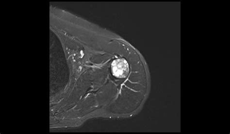Polyostotic Fibrous Dysplasia Mri Radiology Article On Polyostotic