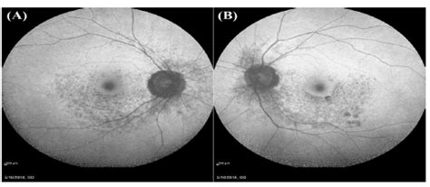 5 Year Progressive Bulls Eye Maculopathy Despite Cessation Of