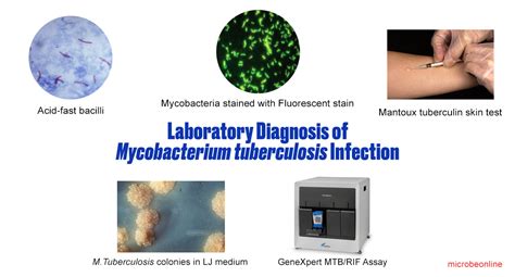 Laboratory Diagnosis Of Mycobacterium Tuberculosis Infection • Microbe