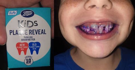 A Mom Shared How Chewable Dental Tablets Helped Her To See If Her Son Brushed His Teeth Properly