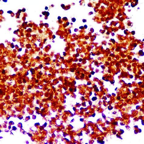 Malignant Tumor Cells Hande X400 Download Scientific Diagram