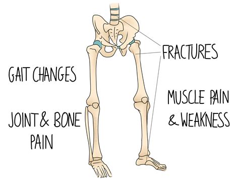 Osteomalacia Bone Disease