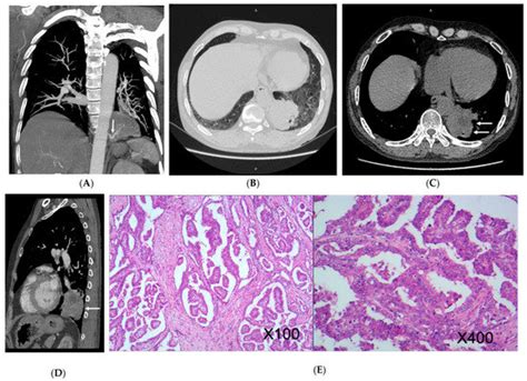Computed Tomography Imaging Features Of Pulmonary Sequestration