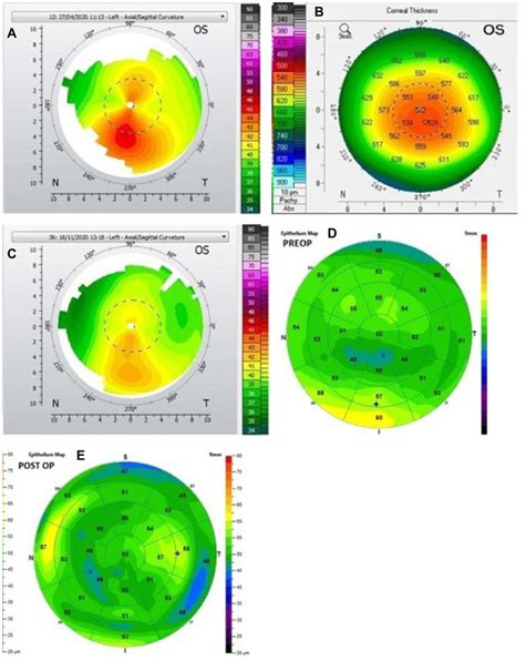 A Case 3 Left Eye Pre Op Topolyzer B Pentacam Pachymetry C