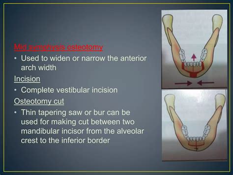 Mandibular Osteotomies Pptx