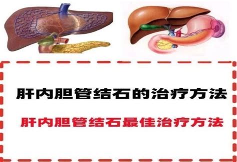 胆管结石 青海大学附属医院