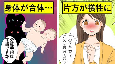 【実話】連結した双子もし結合双生児になったらどうなる？ Youtube